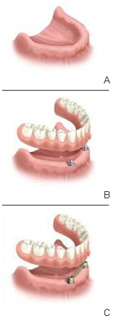 Denture Stabilization Virginia Beach VA, Konikoff Hoag & San Dental ...