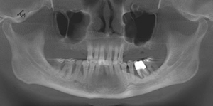 Simplant® Virginia Beach VA, Konikoff Hoag & San Dental Implants ...